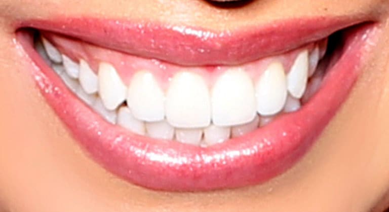Smile Gallery | Beverly Hills Institute of Dental Esthetics