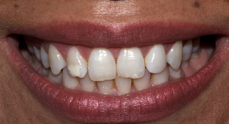 Smile Gallery | Beverly Hills Institute of Dental Esthetics