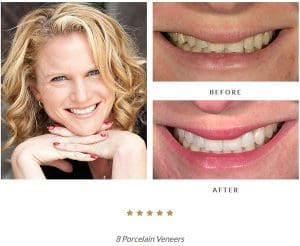 Can I Trust Smile Makeover Before and After Pictures?