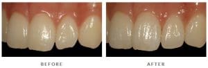 What Are My Options for a Broken Lower Left Front Tooth?